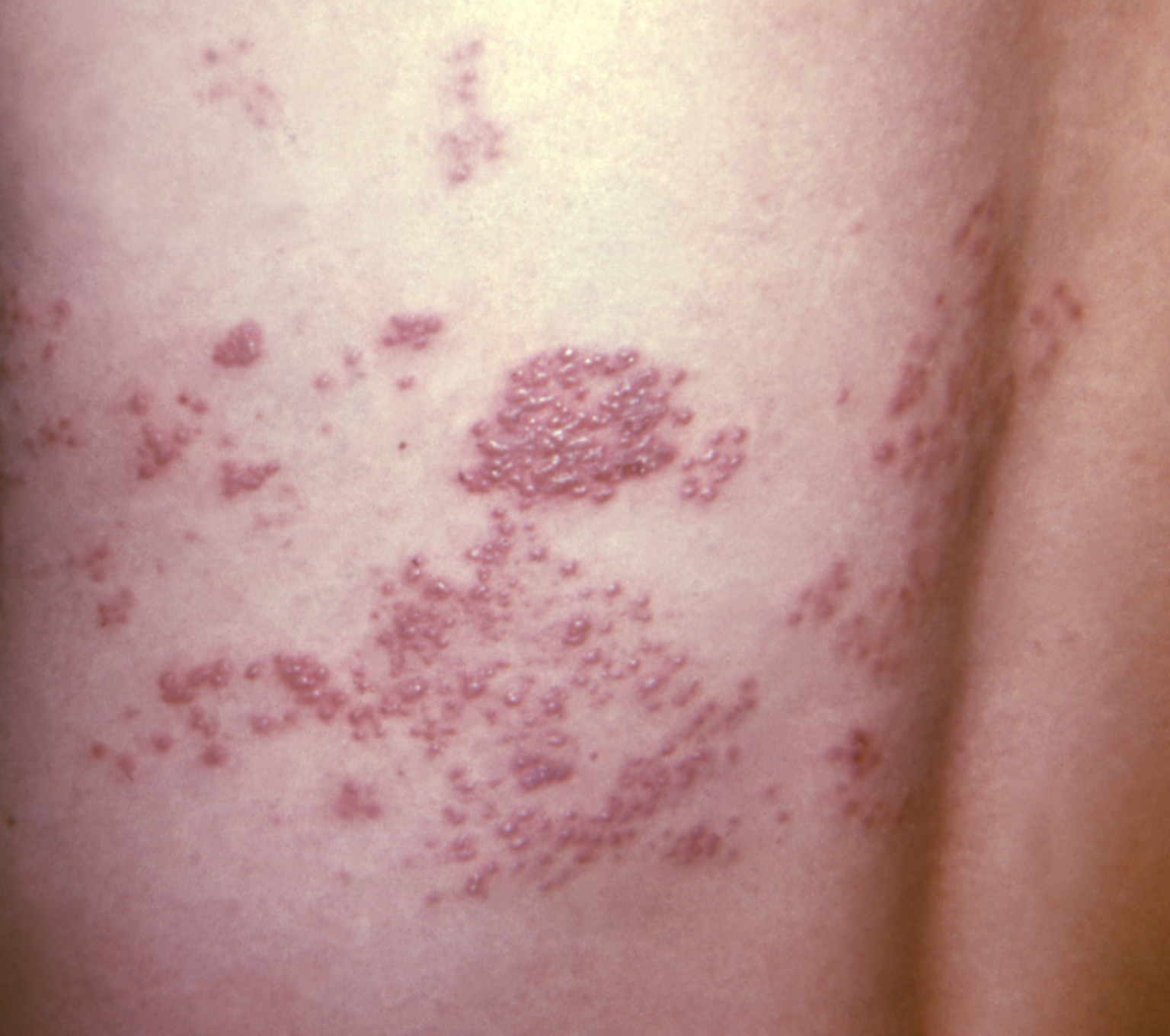 What is Shingles? - Edmonds Medical Clinic