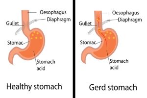 Have you ever heard “GERD”? - Edmonds Medical Clinic