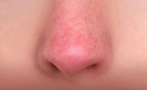 Rosacea - Edmonds Medical Clinic